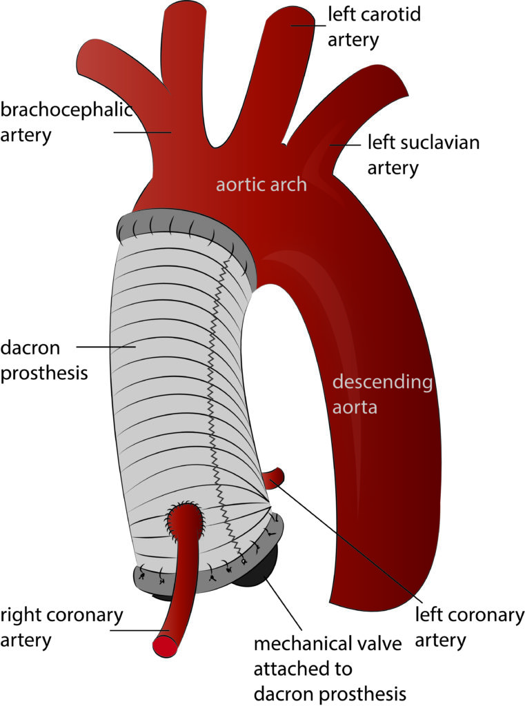 Aortic Surgery Kardiohirurgija rs