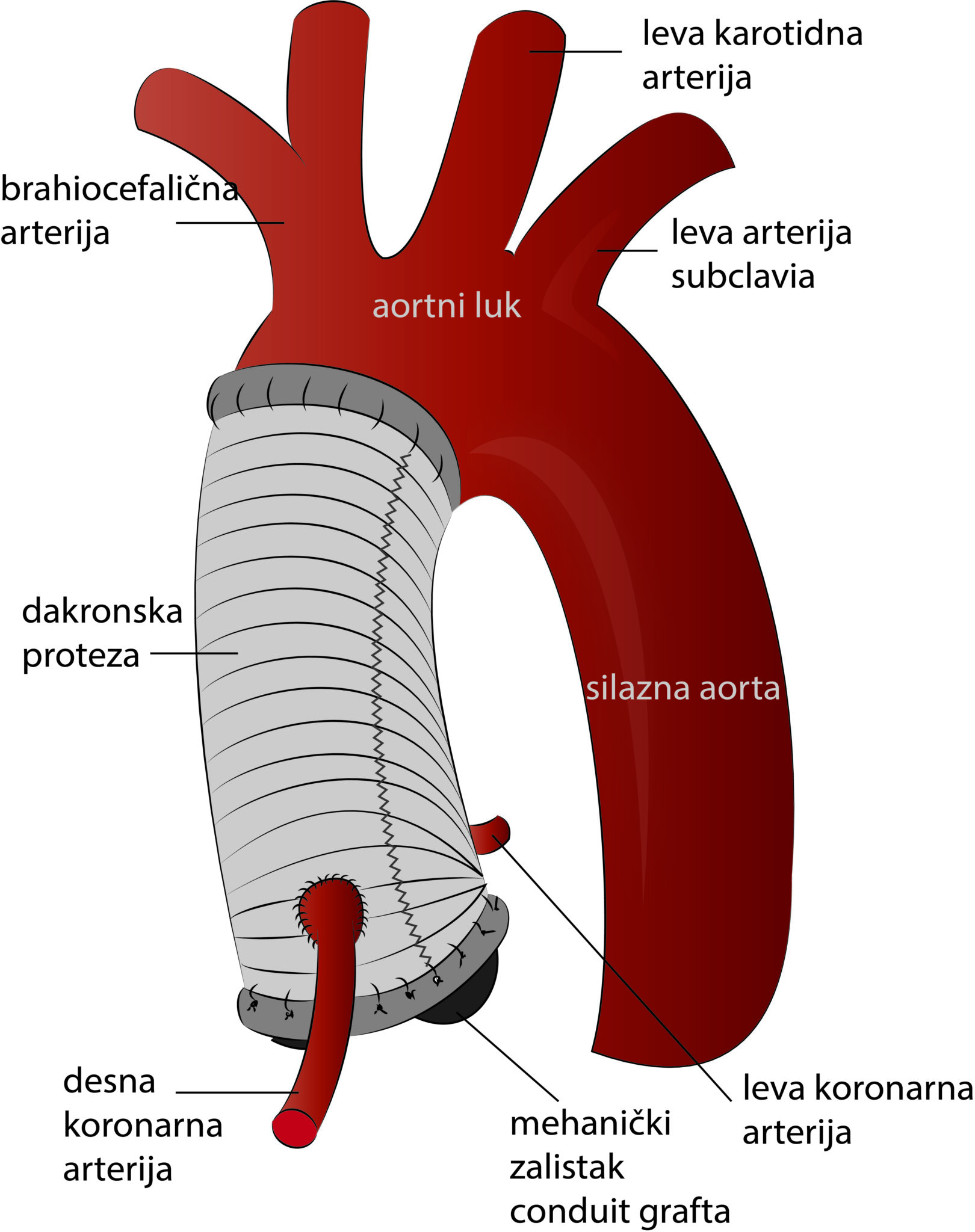 Hirurgija Aorte - Kardiohirurgija.rs